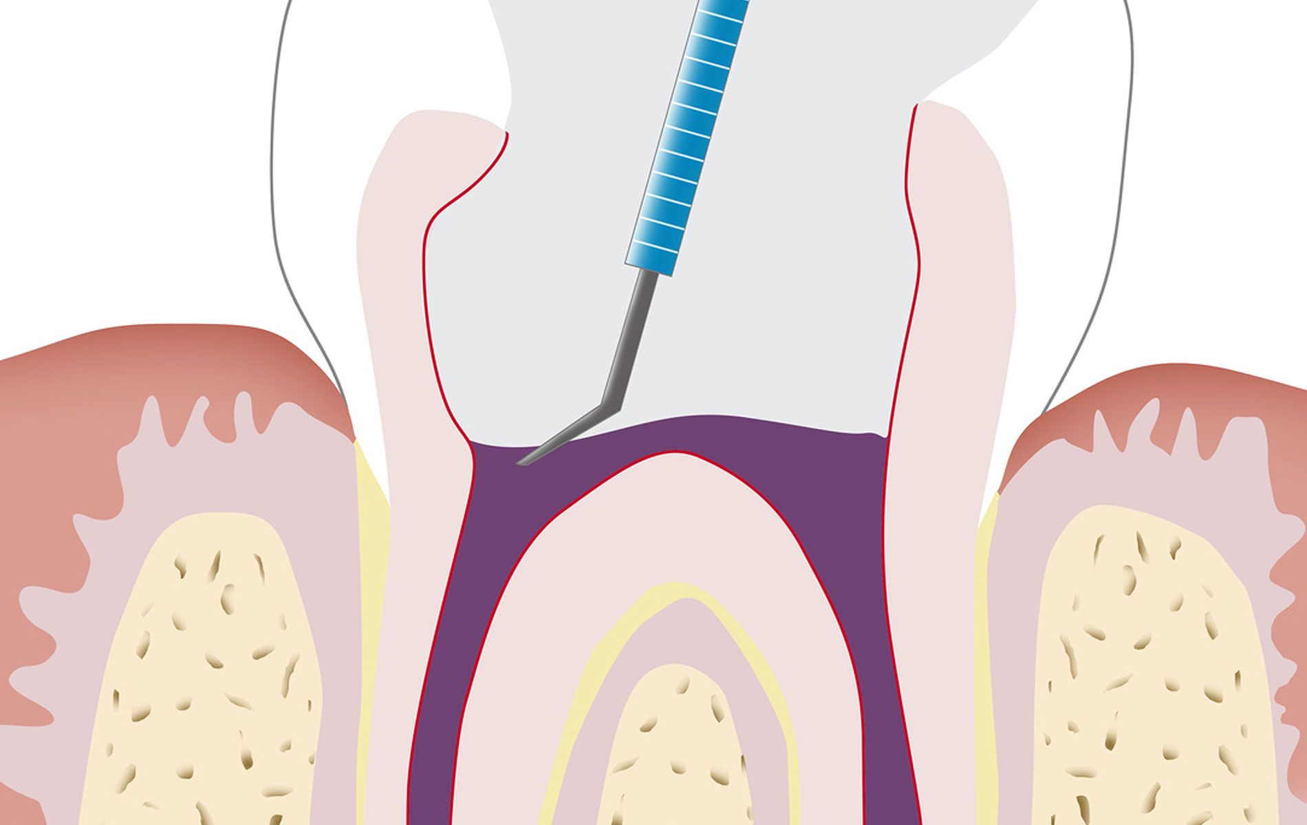 Endodontologie - Zahnarztpraxis Dres. Zimny Berlin